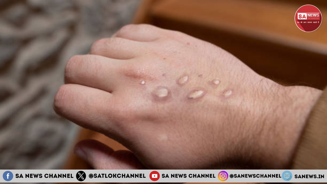 Monkeypox: India Watches Closely Public Health Emergency, Citizens ...